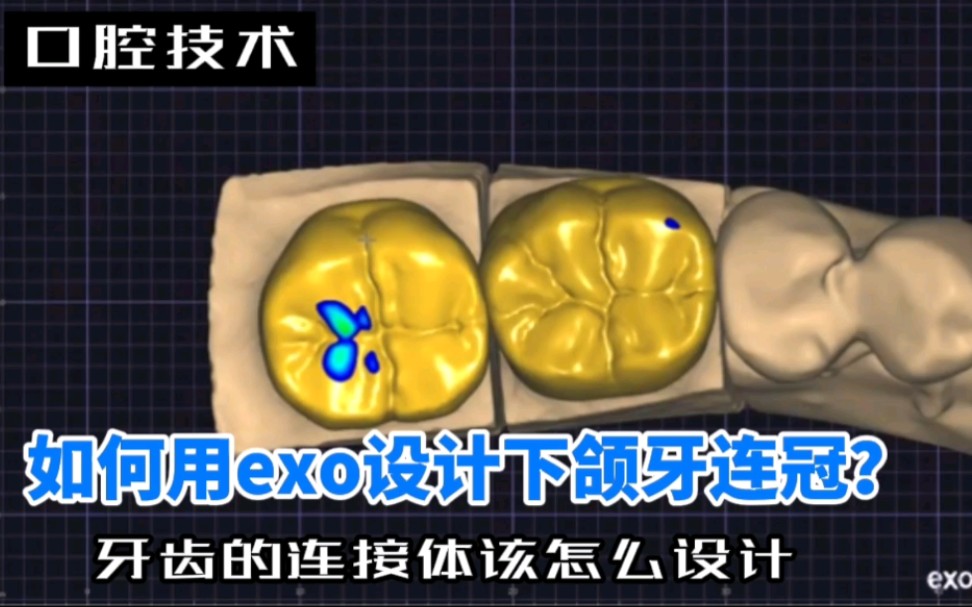 [口腔修复技术]如何用exocad设计下颌六七牙齿连冠