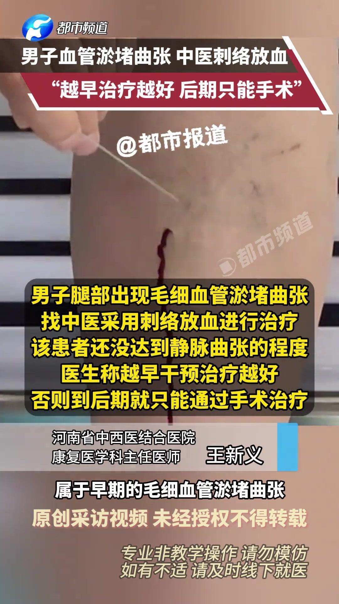 男子血管淤堵曲张,中医扎针放血,"越早治疗越好,后期只能手术"#中医#...