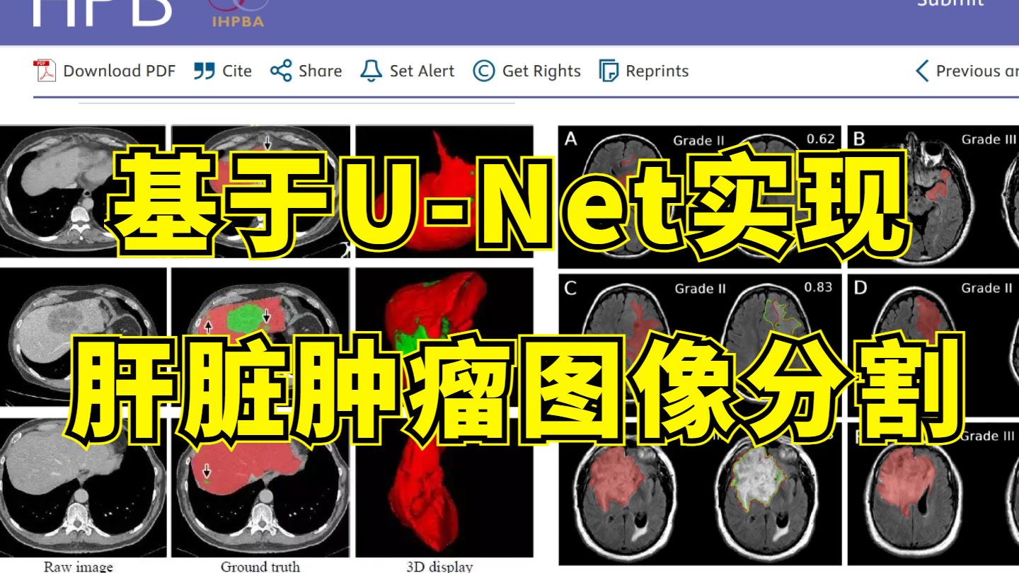 【深度学习医学影像实战】基于U-Net的肝脏肿瘤精准分割教程:从零...