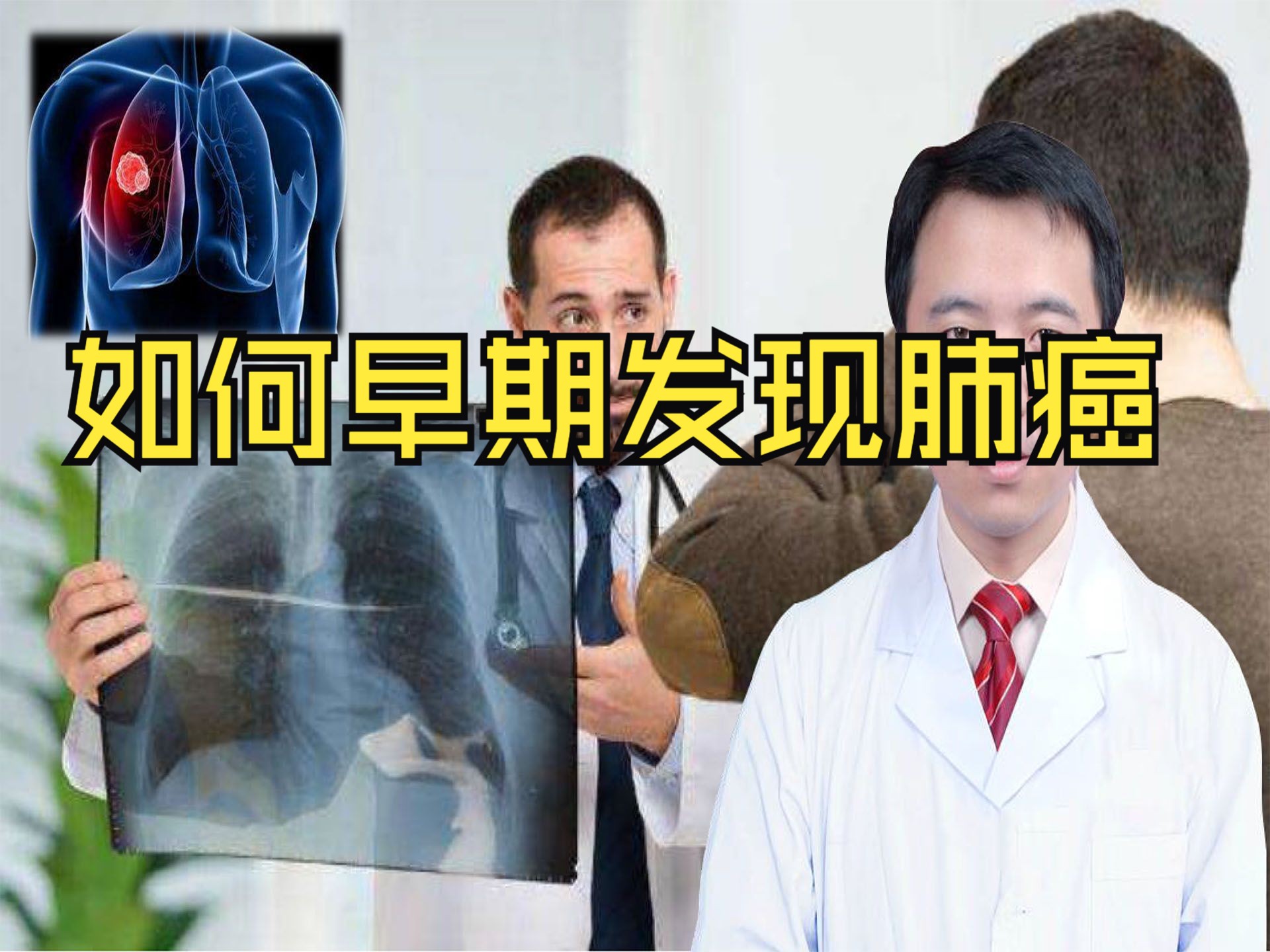 咳嗽发现中央型肺癌,已无手术机会,如何早期发现肺癌