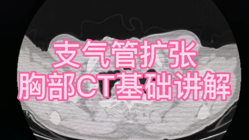 双肺支气管扩张,胸部CT,基础知识讲解,零基础入门