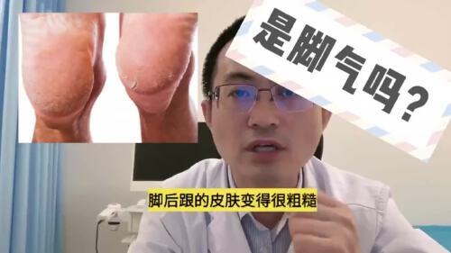 脚后跟干裂起硬皮,到底是不是脚气?