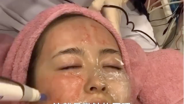 一位小姐姐在做微针,这个项目可以改善毛孔让皮肤更细致#医美# #医美...