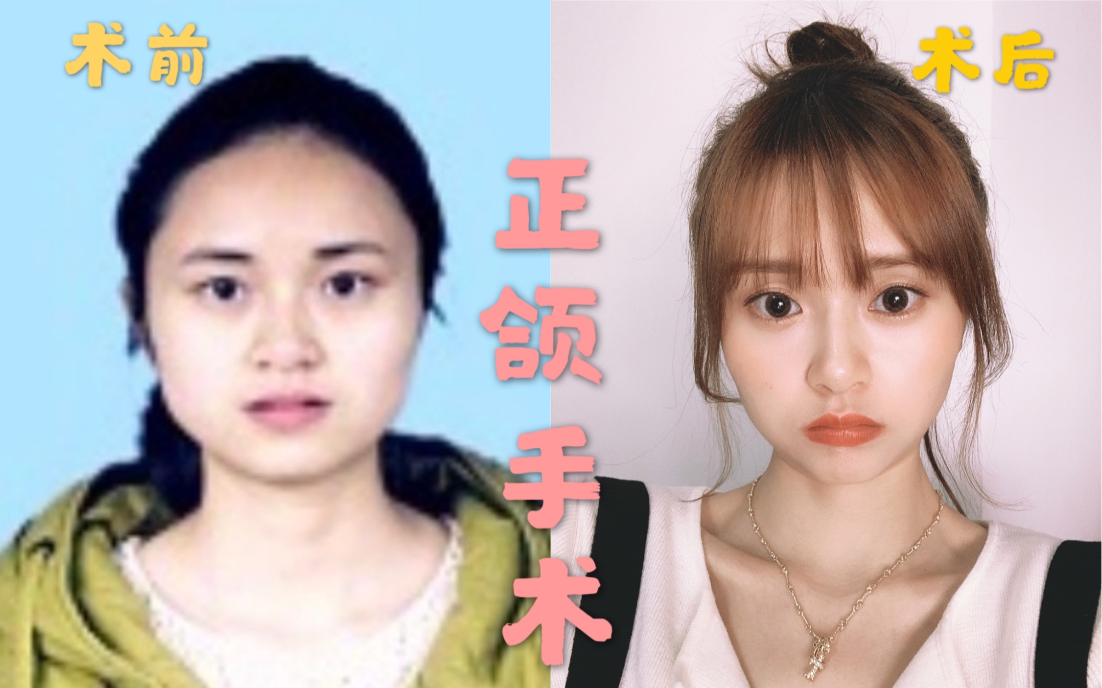 你不知道的正颌手术细节全过程,手术中还削了下颌角是种什么操作?