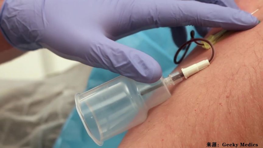 血培养采集的方法及注意事项