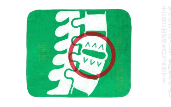 脊柱椎间盘融合固定手术视频简单演示