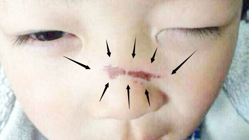 ...有疤痕很难看?美容师教你一招,用家家都有的它涂抹,不花钱就能去除