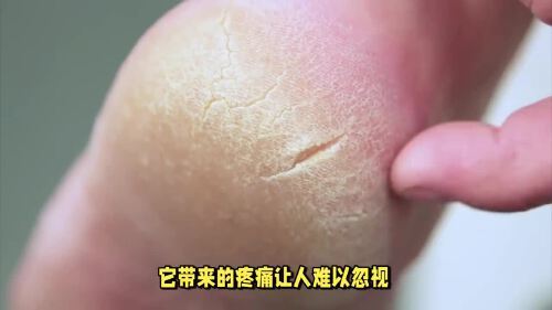 脚后跟干裂起硬皮裂口子怎么办?教你几招生活小妙招