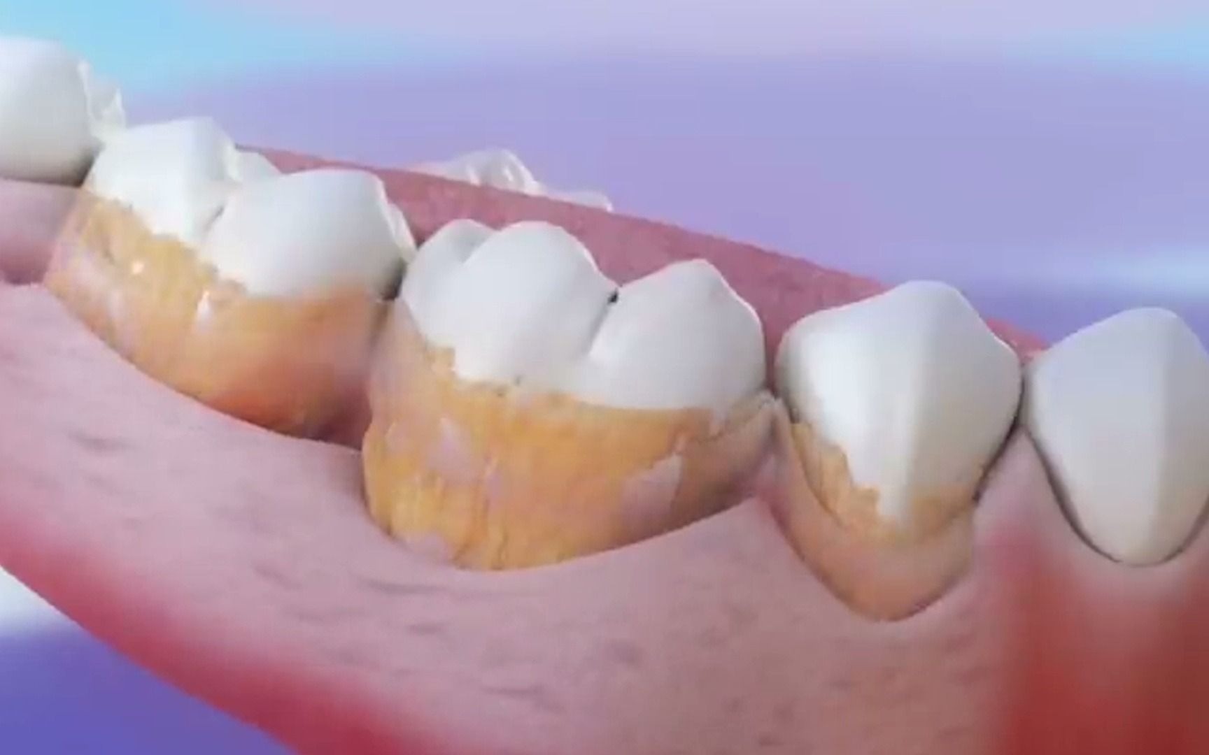 龈下刮治,是治疗牙周病的有效手段之一!