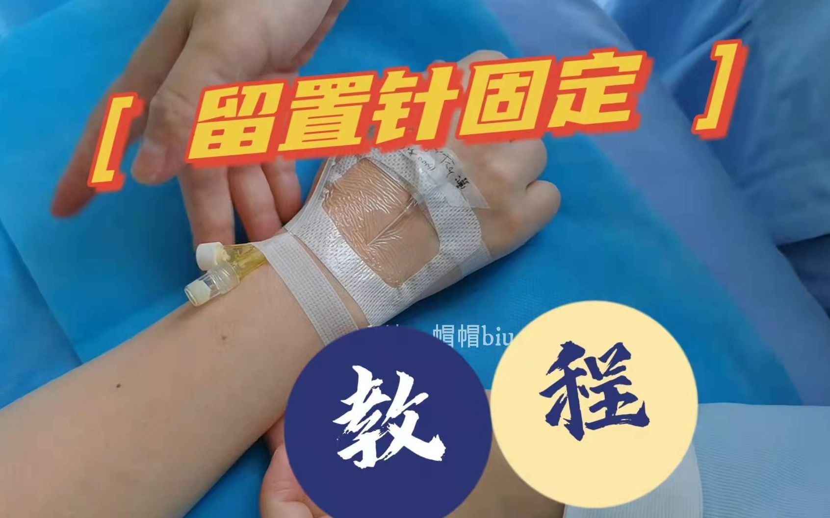 【帽帽】被催更的。留置针固定教程~