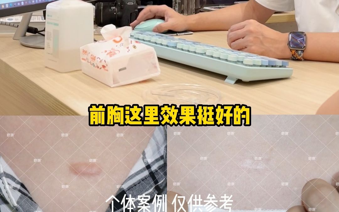 疤痕疙瘩,恢复成这样你满意吗?