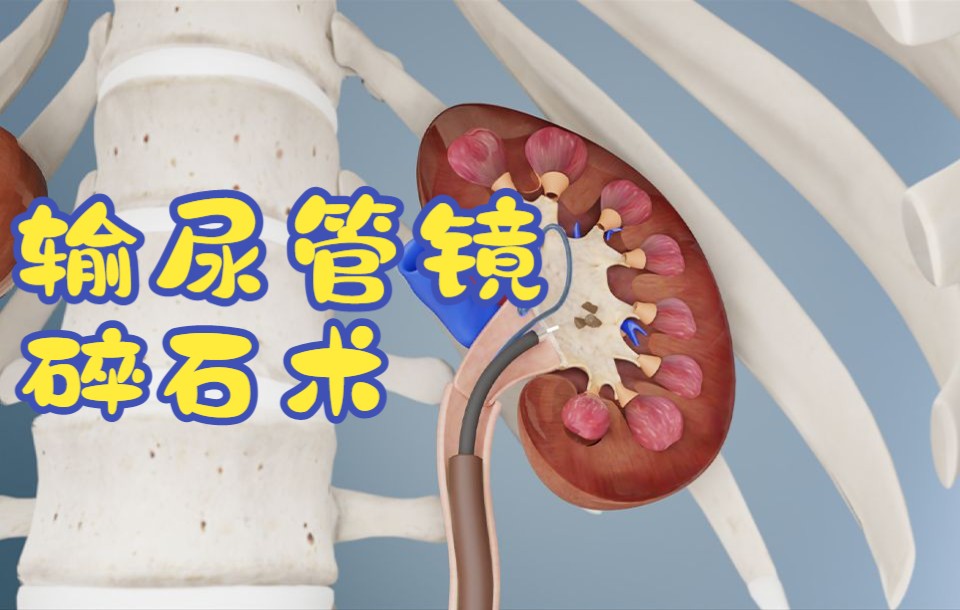 【疾病的奥秘】:3D还原--输尿管镜碎石术
