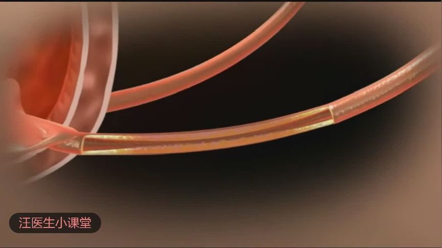 3D动画演示支架治疗输尿管狭窄,术后就通畅了!