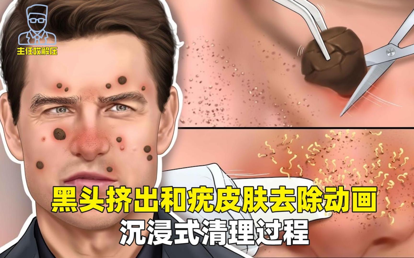 解压动画,黑头挤出和疣皮肤去除动画,沉浸式清理