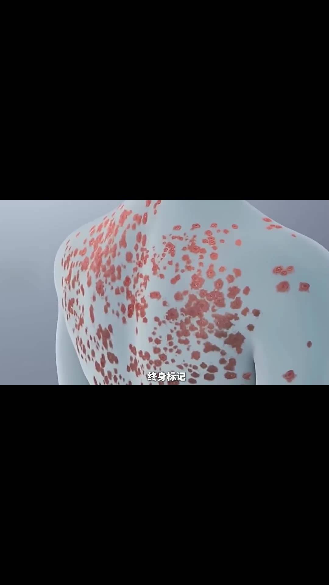 一次感染,终身标记,幽灵般的梅毒究竟有多可怕