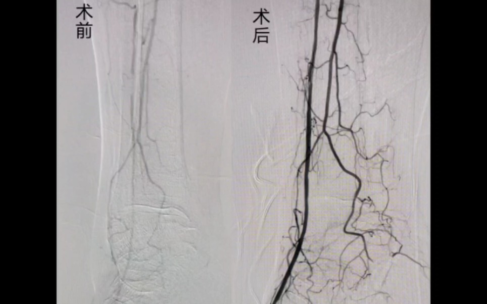 下肢动脉硬化闭塞逆行穿刺开通