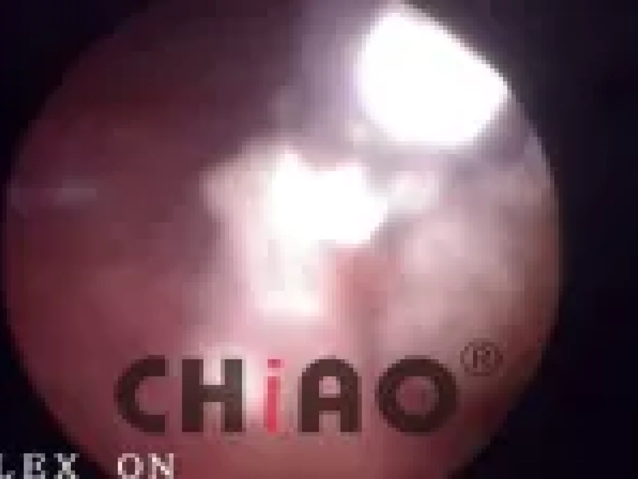 钳胆囊息肉及电凝止血内窥镜微创手术