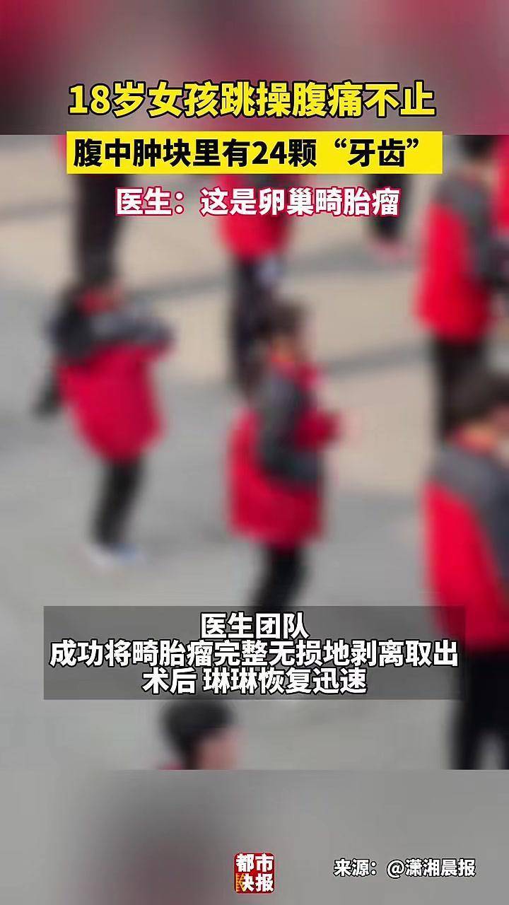 18岁女孩跳操腹痛不止,腹中发现巨大肿块,里面还有24颗牙齿!