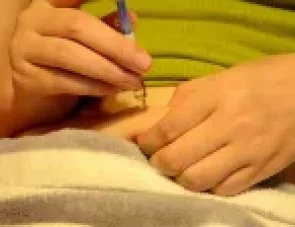 皮下注射低分子肝素 高清