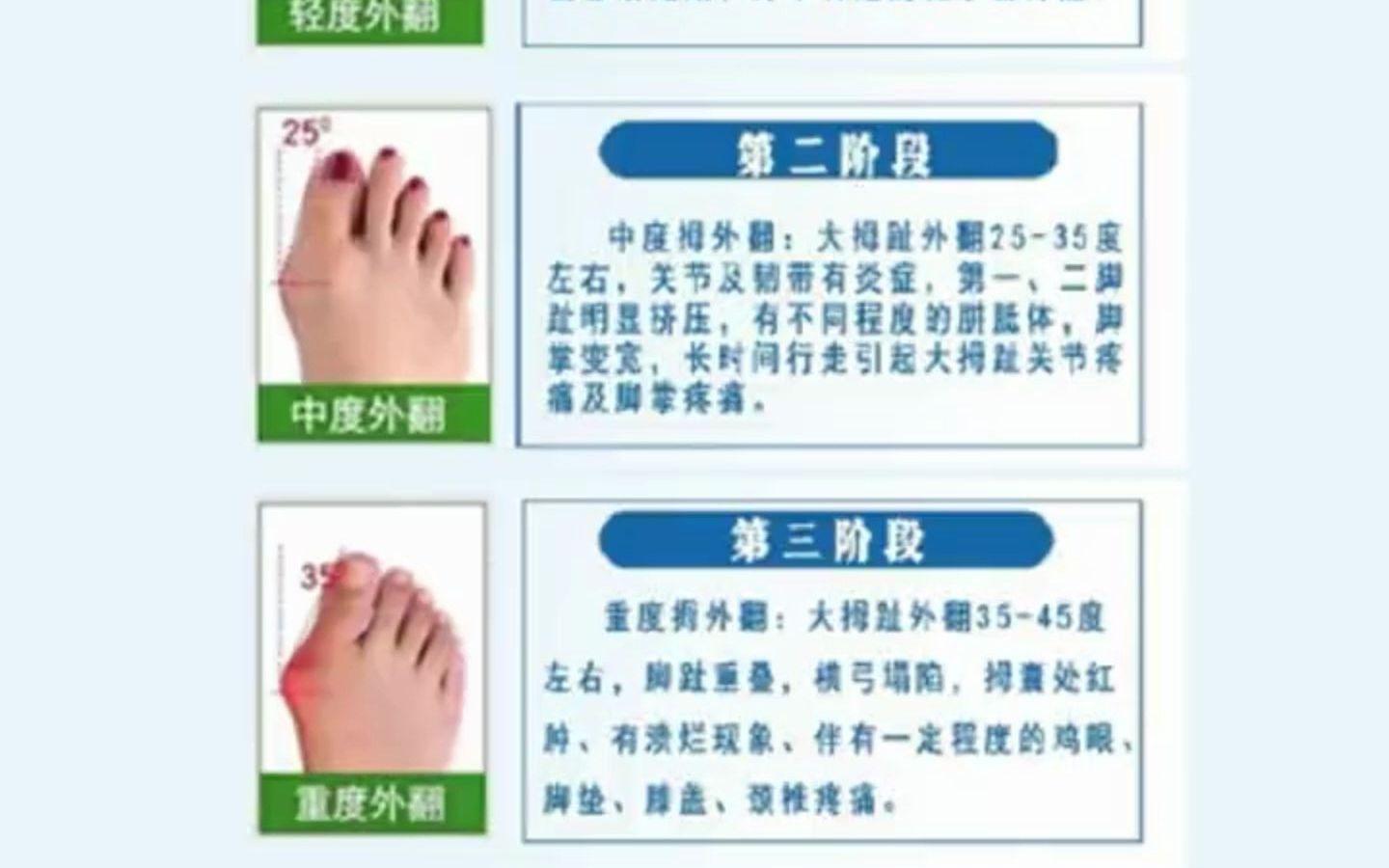 只知道是拇外翻,不知道发展到什么阶段了,一张图告诉你