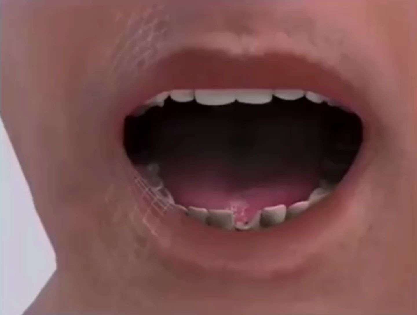 蛀牙只剩残根一定要拔除吗?深圳根管治疗加桩核冠