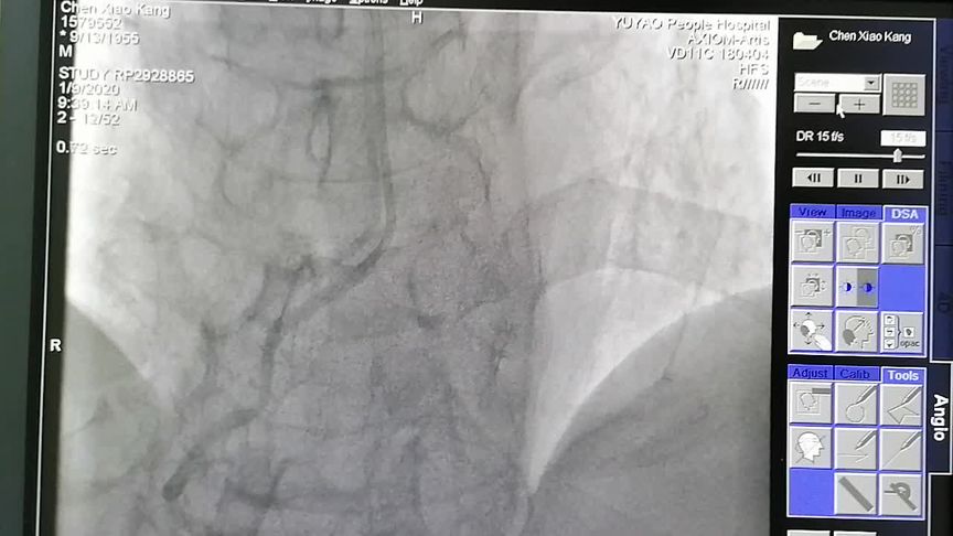 带你近距离了解,正常心脏冠状动脉造影结果,原来是这样的