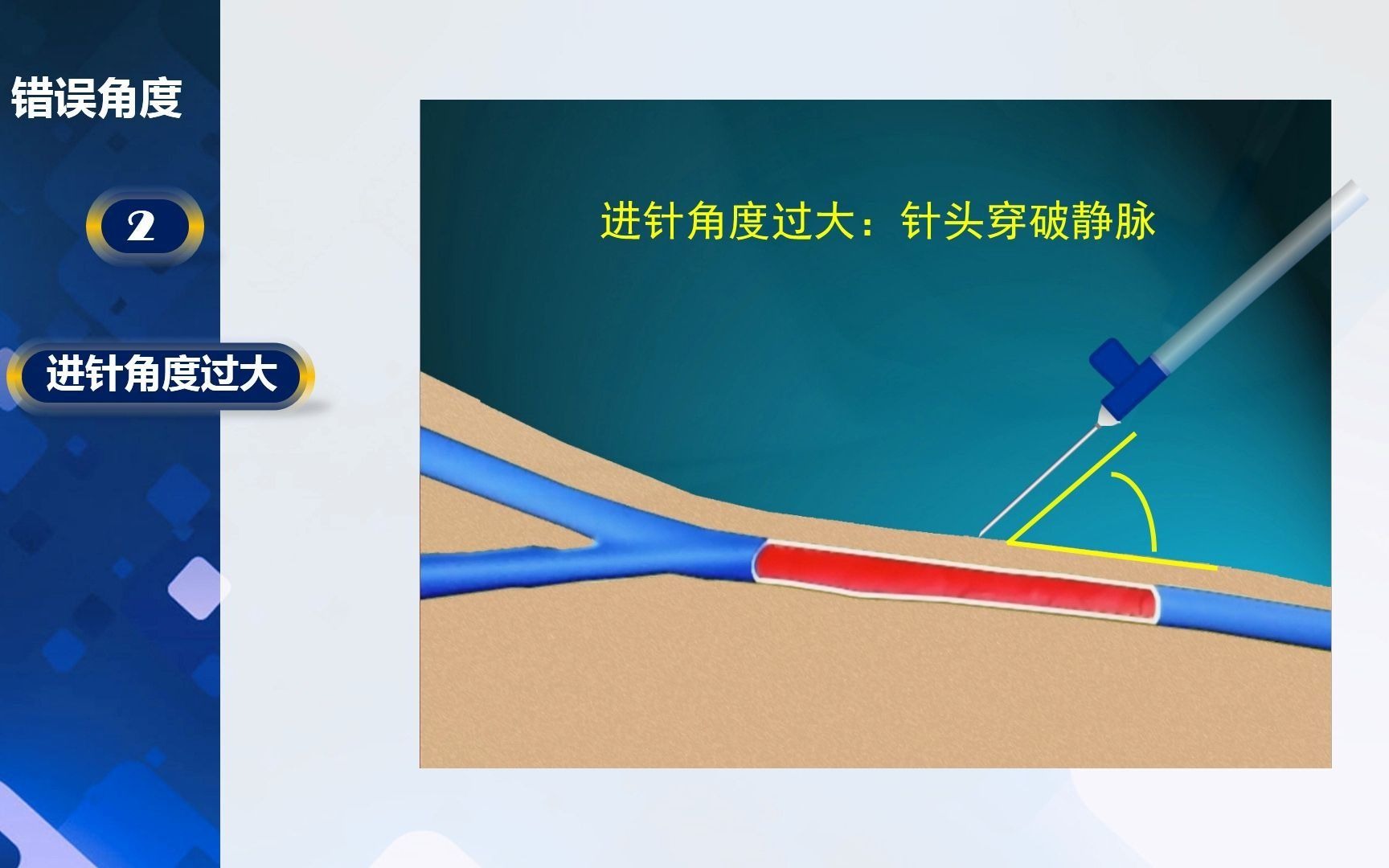 PPT制作医学课件--静脉输液进针的错误角度示意动画