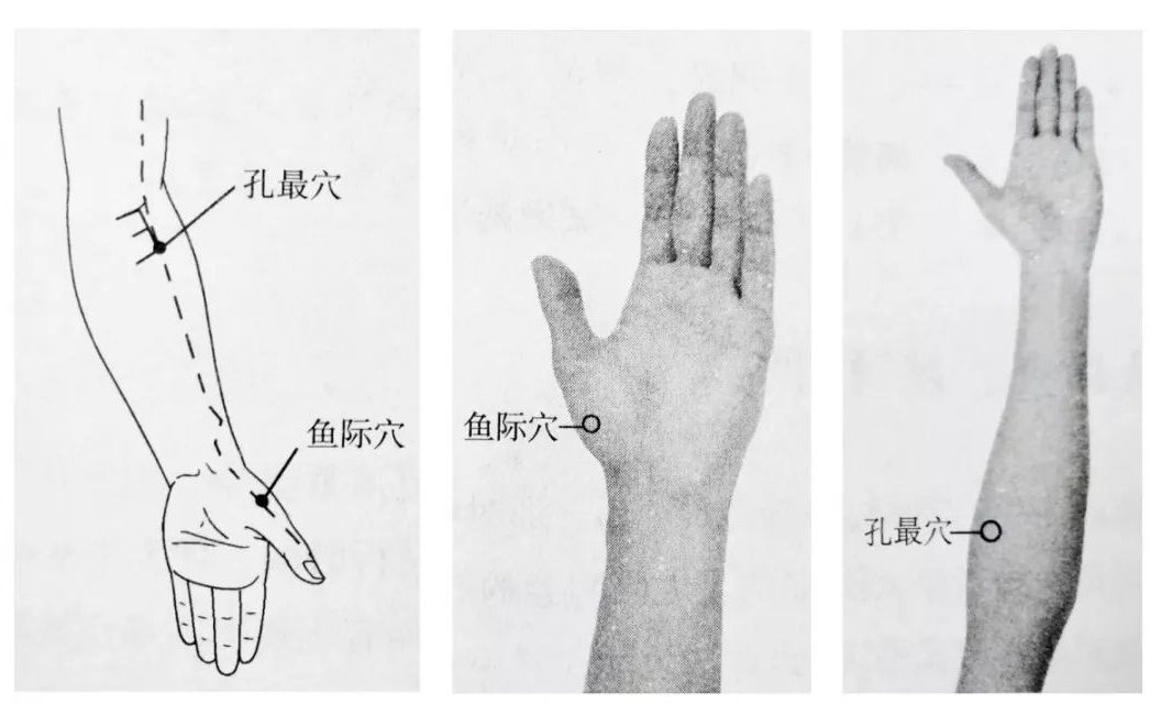 孔最穴 ,大用处。气管炎,咽喉肿痛,痔疮,一个穴位搞定。