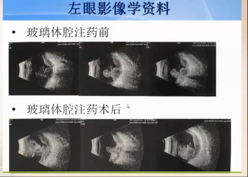 长三角疑难眼底病例讨论会