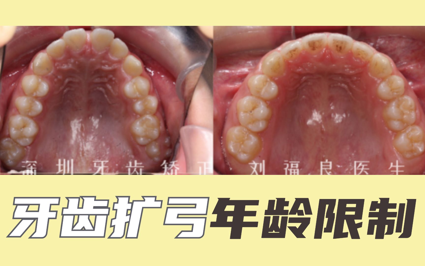 牙齿扩弓有没有年龄限制?牙性扩弓和骨性扩弓的区别是什么?