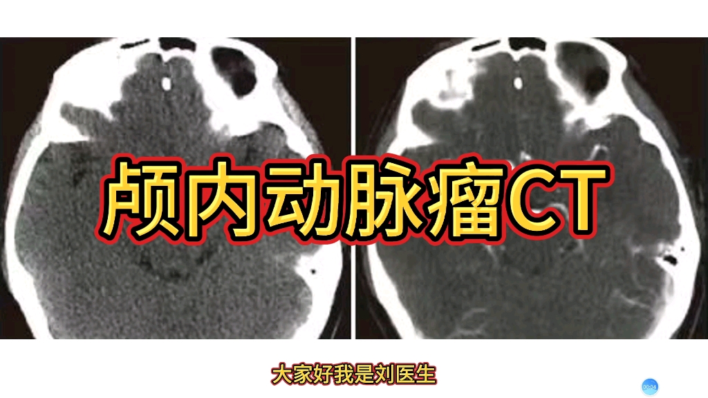 病例分享:颅内动脉瘤CT图像分析讲解,简单易懂!