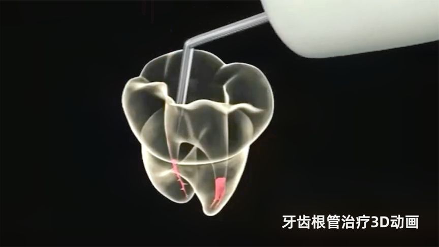 一步步看清牙齿根管治疗全过程,这酸爽一辈子都忘不了!