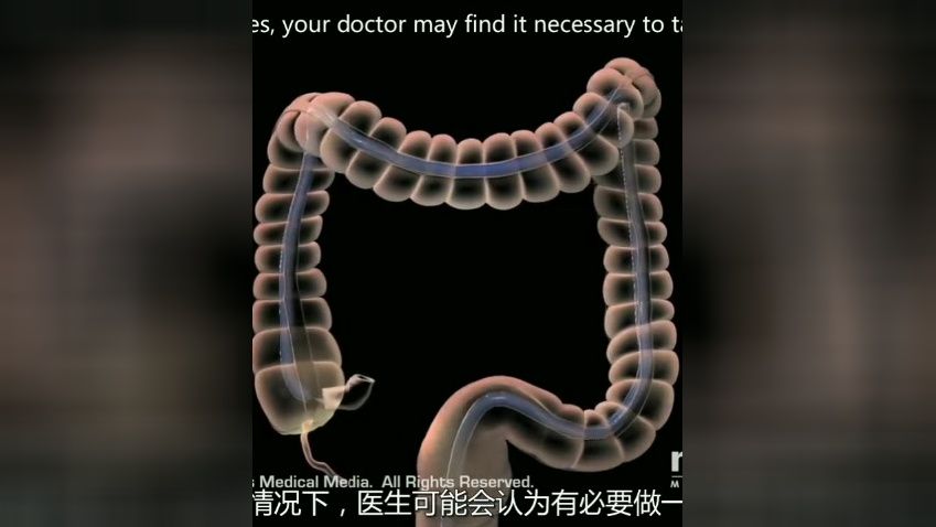 肠镜检查,不到3分钟看完