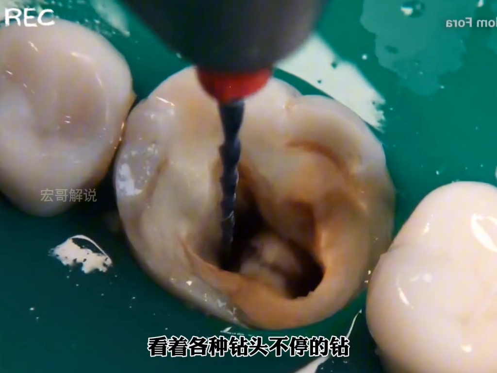 牙齿根管治疗修复全过程#牙齿根管 #牙齿修复 #解压视频