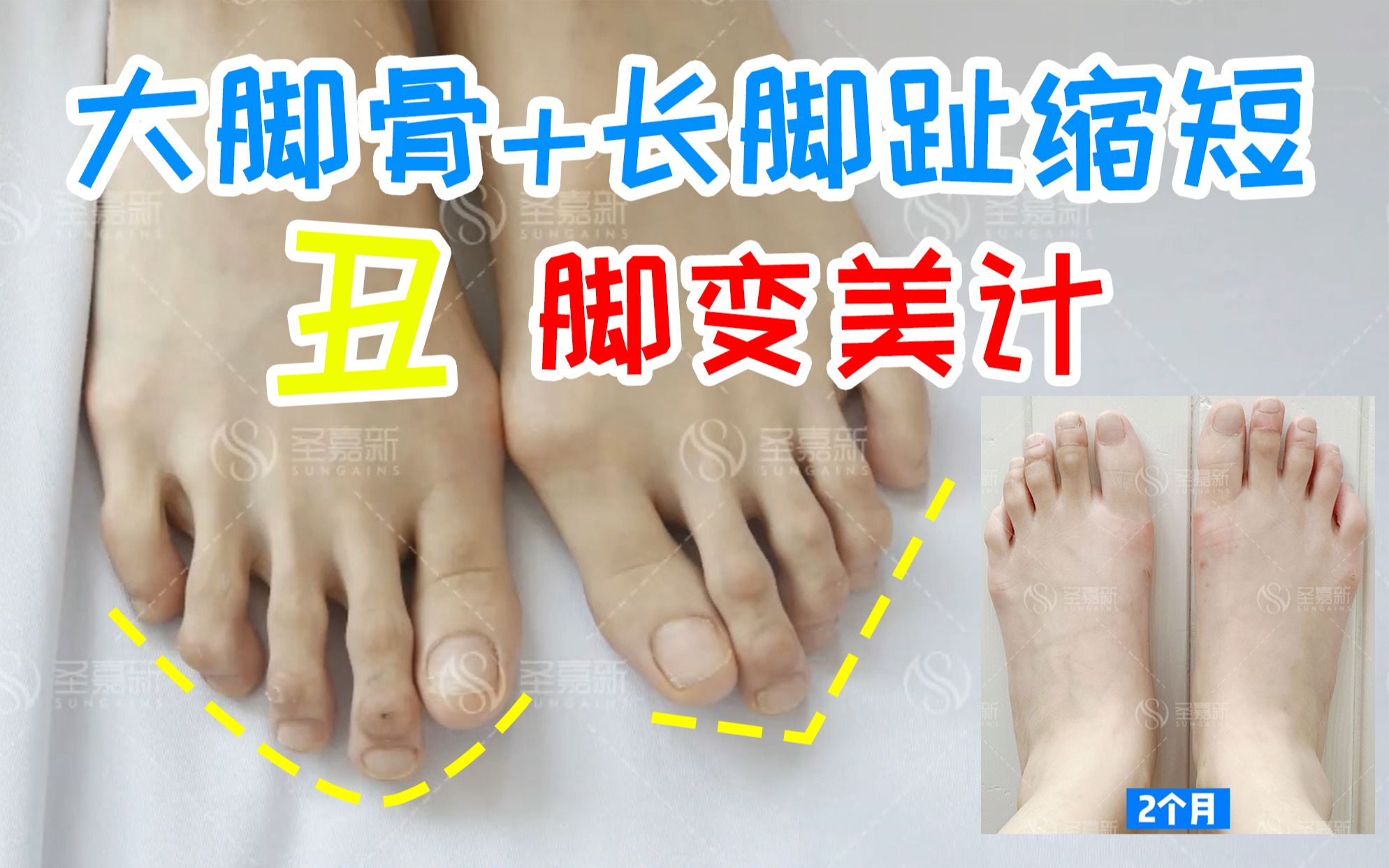 【苏敬达】大拇指外翻+脚趾长畸形,重叠茧子太丑!健身教练的矫正经历