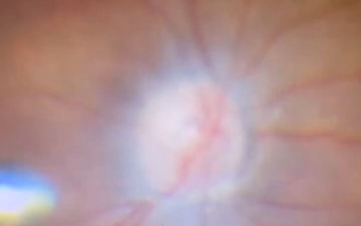 【玻切术中视网膜中央动脉搏动】Central retinal artery pulsation during ...