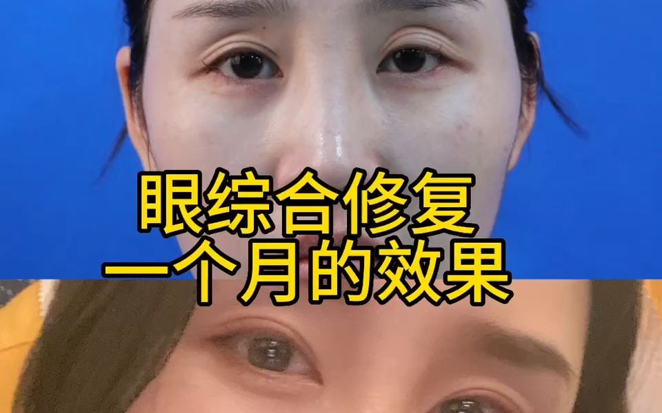 眼综合修复 ● 一个月的效果