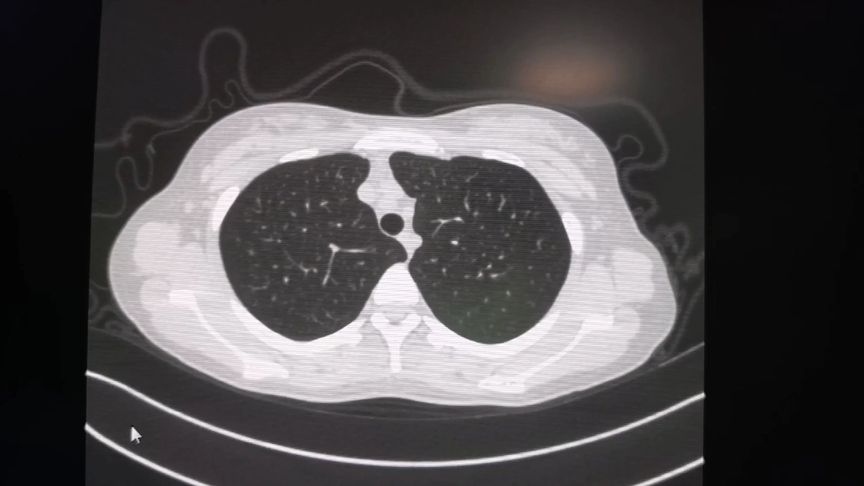胸部CT肺的分叶,如何定位,基础讲解