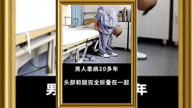 男人患病20多年,头部和腿完全折叠在一起