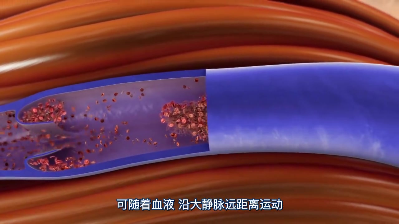 深静脉血栓和肺栓塞