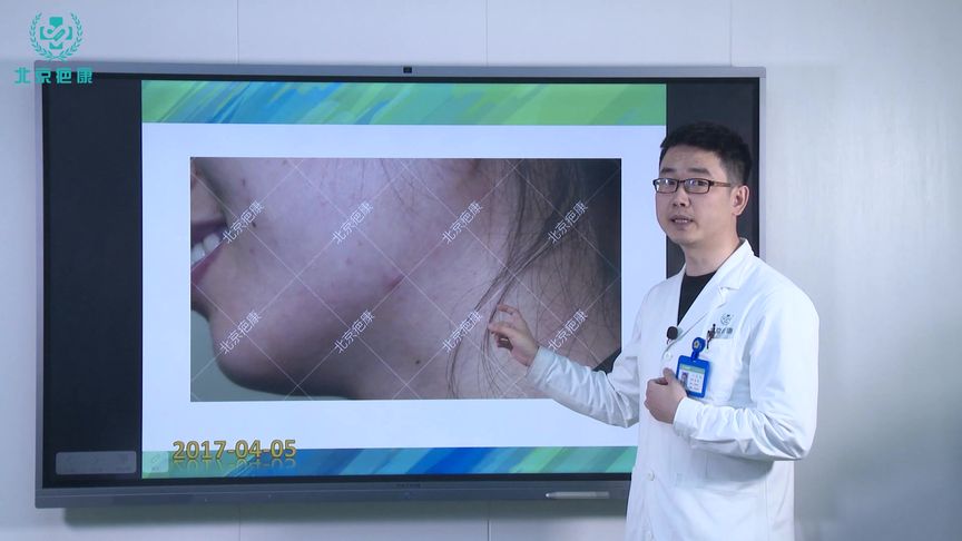 为什么说疤痕疙瘩越早处理越好?看她就知道了!