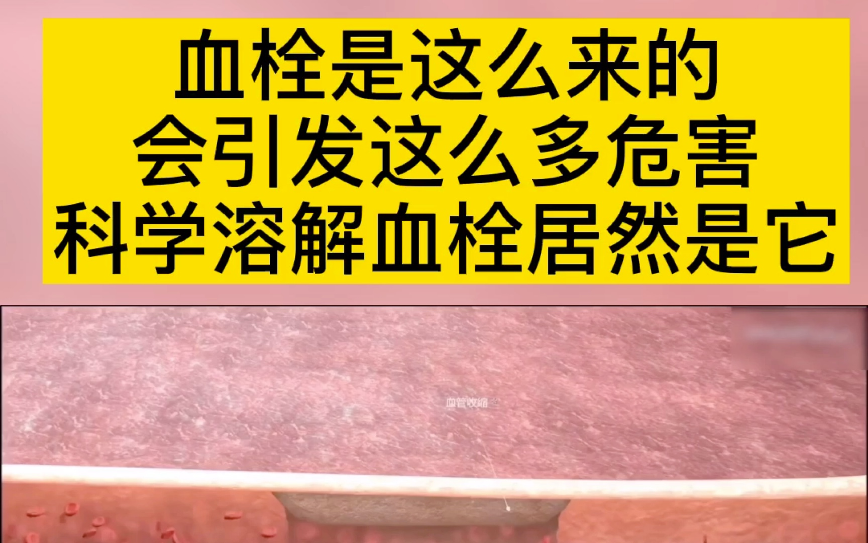 心脑血管疾病罪魁祸首书血栓,血栓来源是这三点,危害太可怕了。