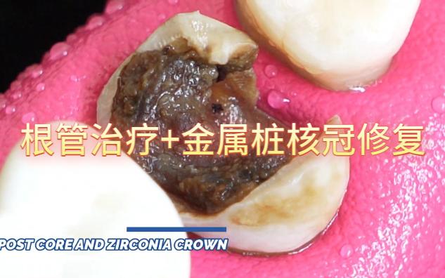 根管治疗+金属桩核冠修复