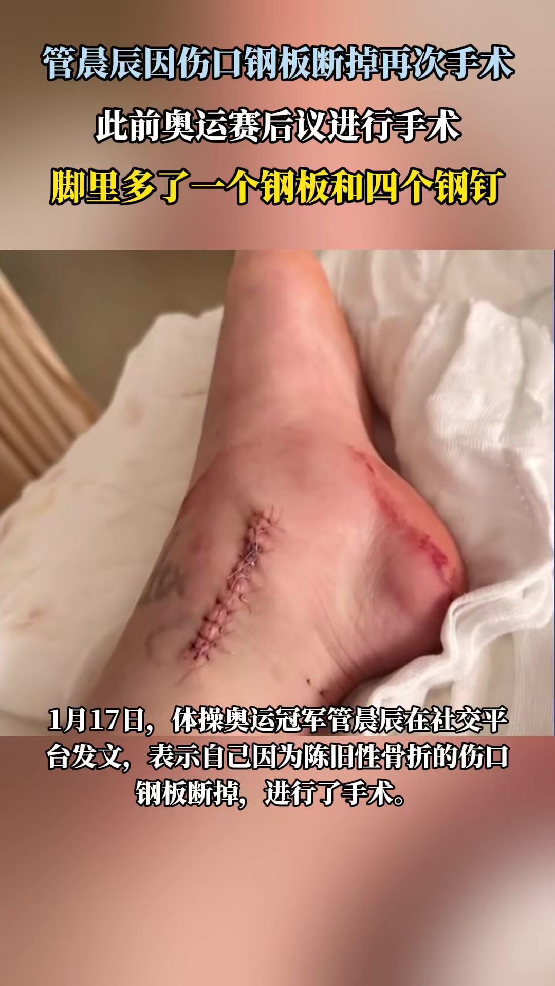 1月17日,体操奥运冠军管晨辰在社交平台发文,表示自己因为陈旧性骨折的伤口钢板断掉,进行了手术。