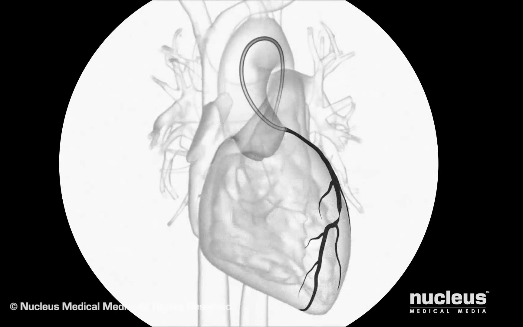 【Nucleus Medical Media+熟肉】经皮腔内冠状动脉成形术