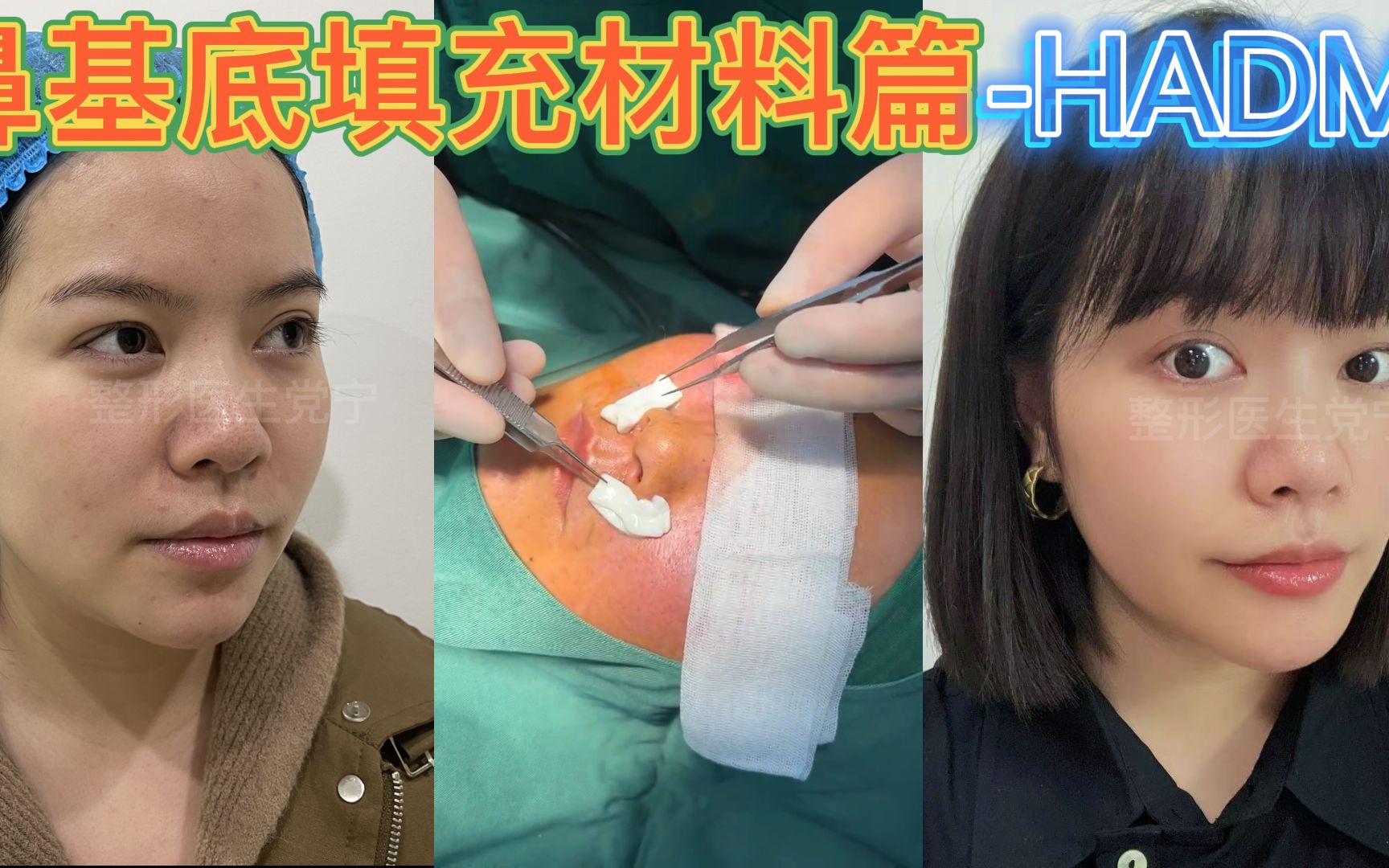 不用动手术,1个动作改善鼻基底凹陷、法令纹深问题