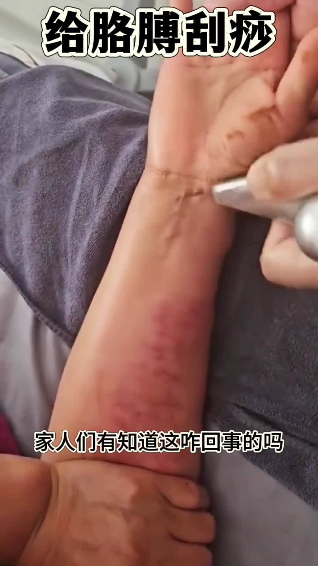小伙让媳妇给手臂刮痧,这力道就差把皮刮掉了