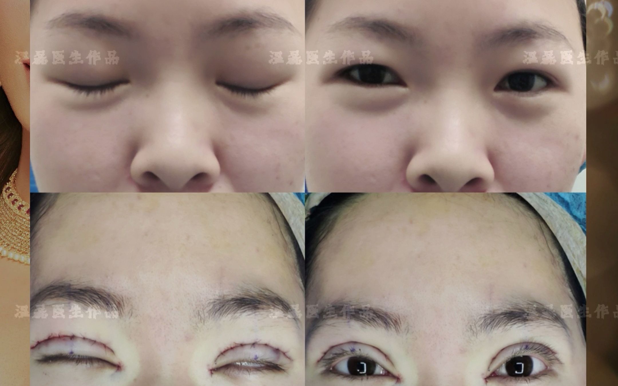 肿眼泡怎么去除?经常有求美者这样问,其实去除肿眼泡主要是去除眶膈...