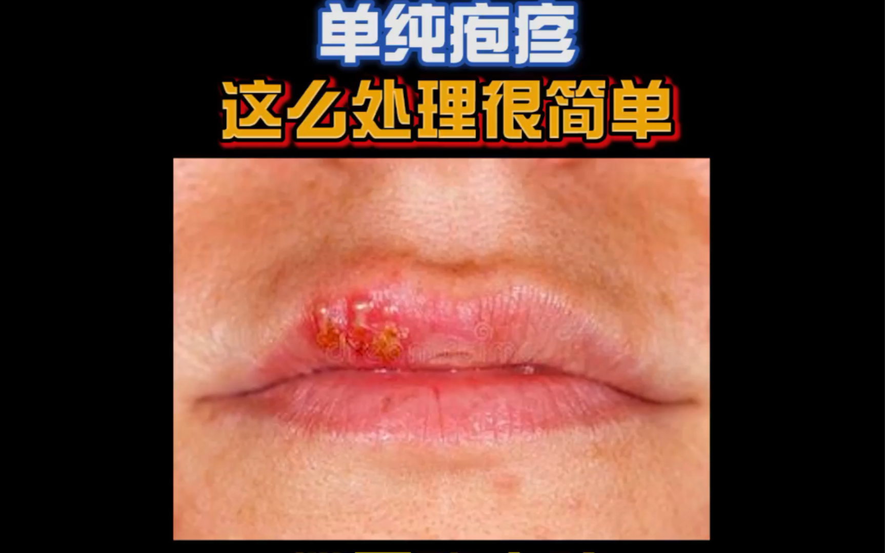 单纯疱疹,这么处理很简单