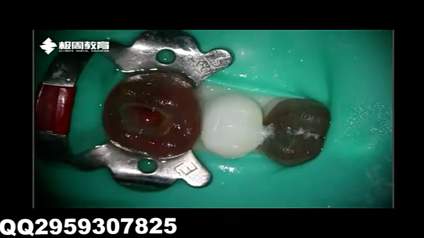 乳牙根管治疗术及操作技巧——洪胜老师